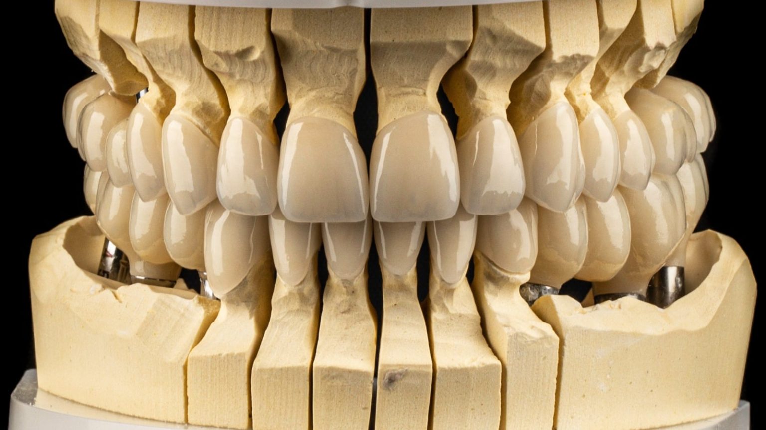 Les différents types de zircone, couronne dentaire